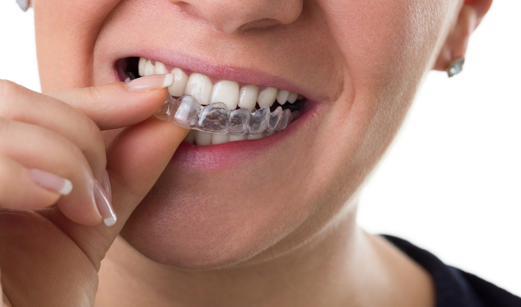 Invisible Treatments: Invisalign or Lingual Braces?